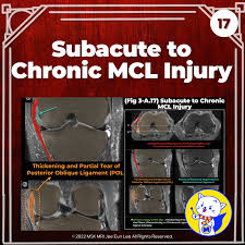 Understanding MCL Injury: Causes, Symptoms, and Re...